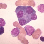BloodLine | Continuing Medical Education for Hematology